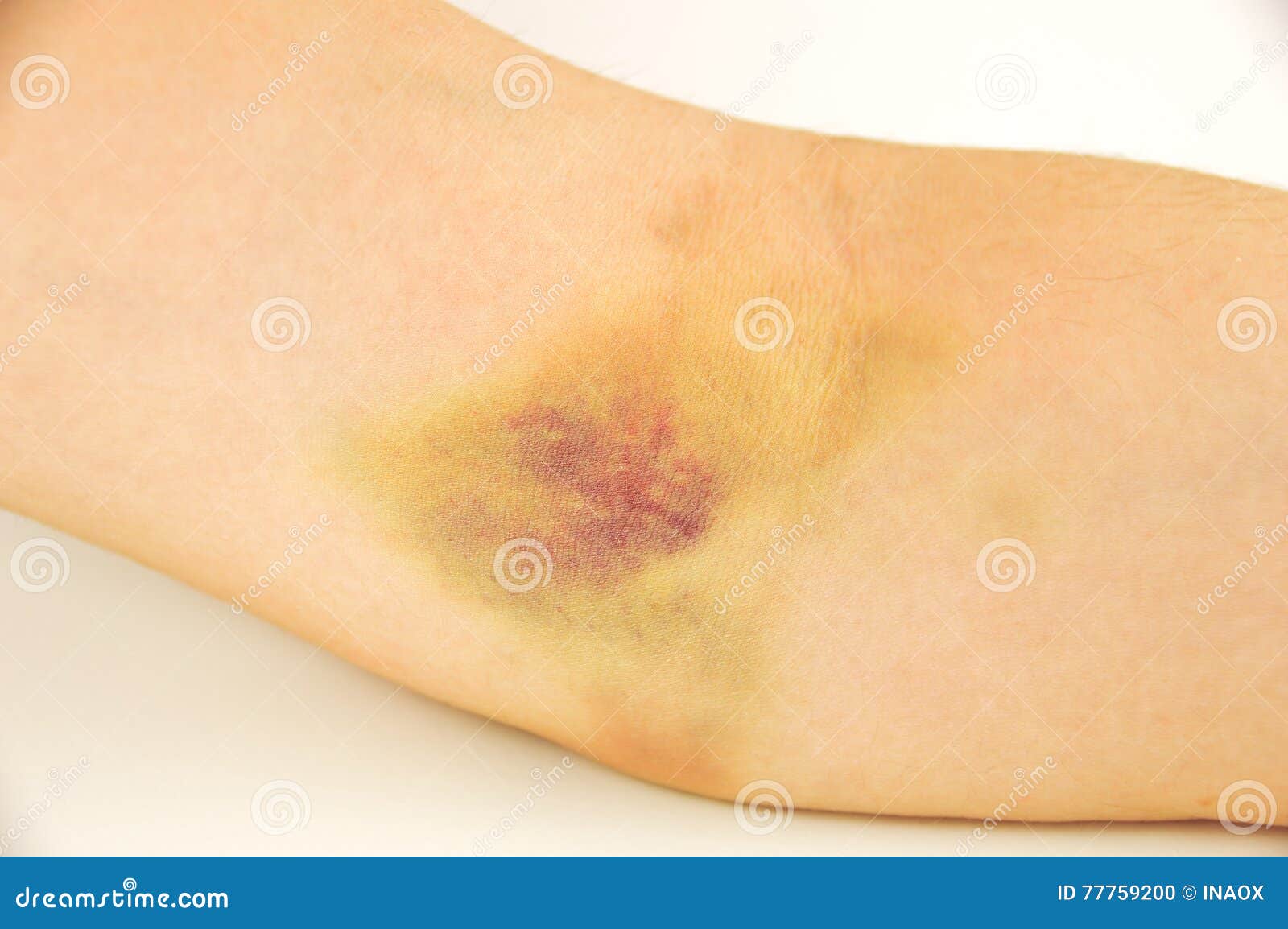 Bruise in the arm stock photo. Image of beaten, beating - 77759200