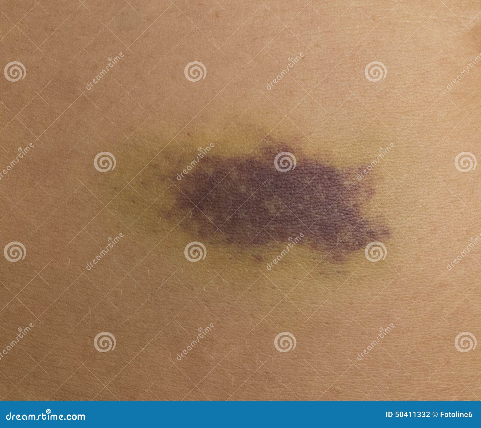 Bruise stock photo. Image of healthcare, blood, pain - 50411332