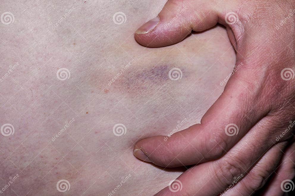Bruise on the body stock photo. Image of trauma, caucasian - 231107110