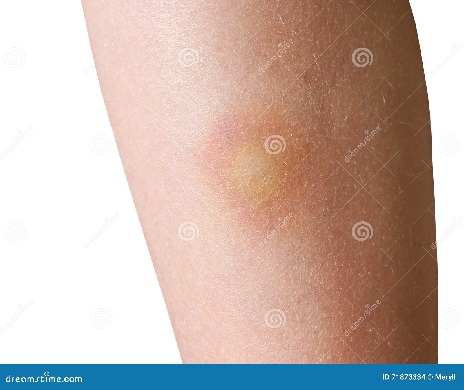 Bruise stock photo. Image of medical, scab, healthcare - 71873334