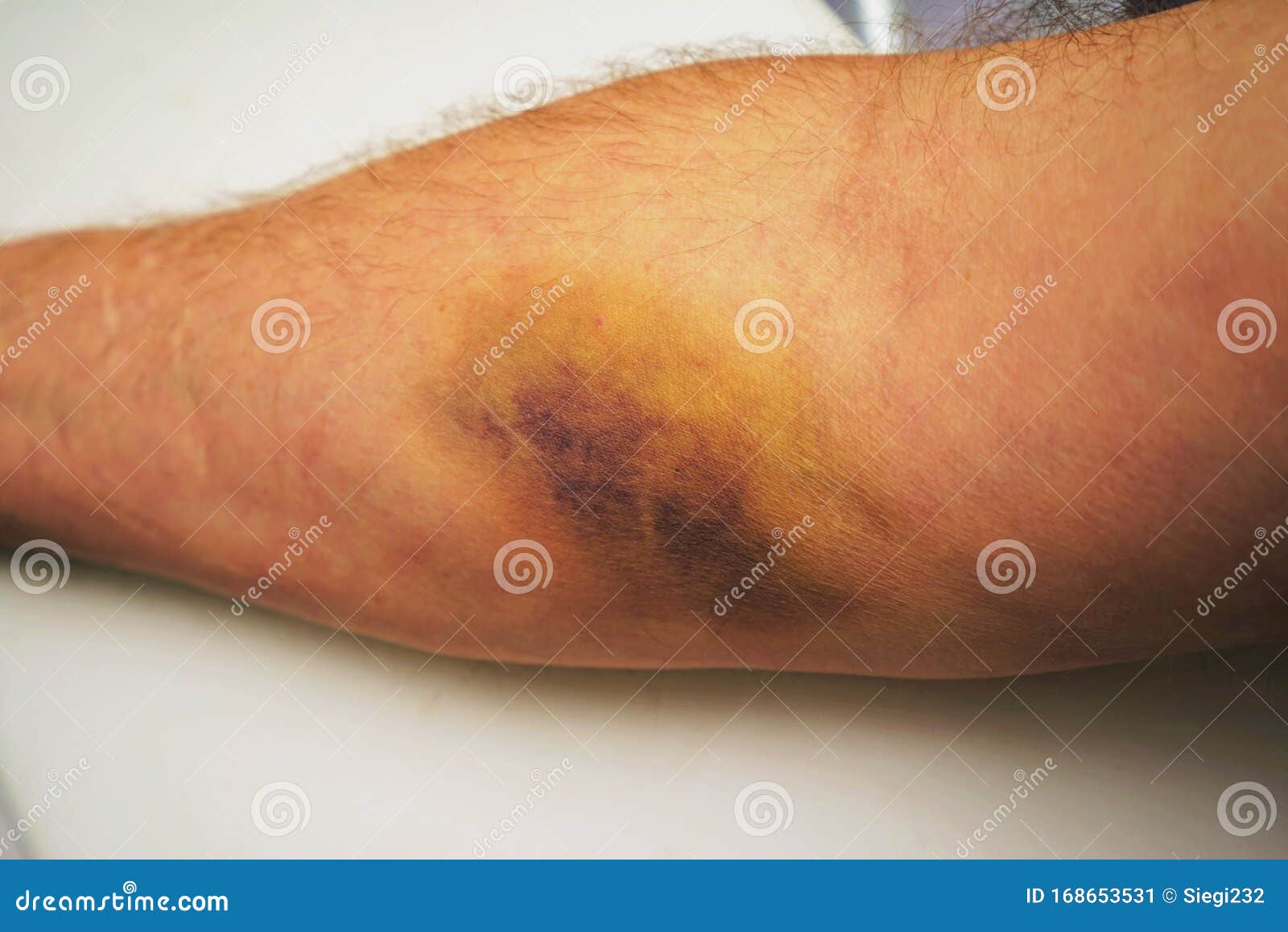 A Bruise on the Forearm Caused by a Syringe Stock Image - Image of ...