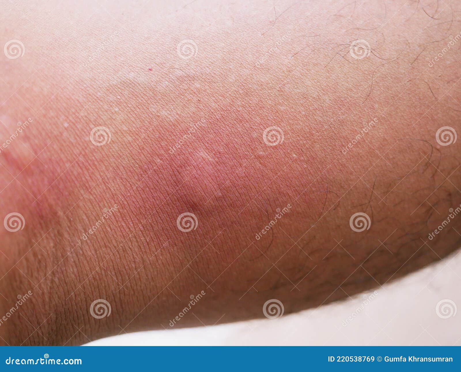 A Bruise that Has Been Stung by an Insect Stock Image - Image of care ...