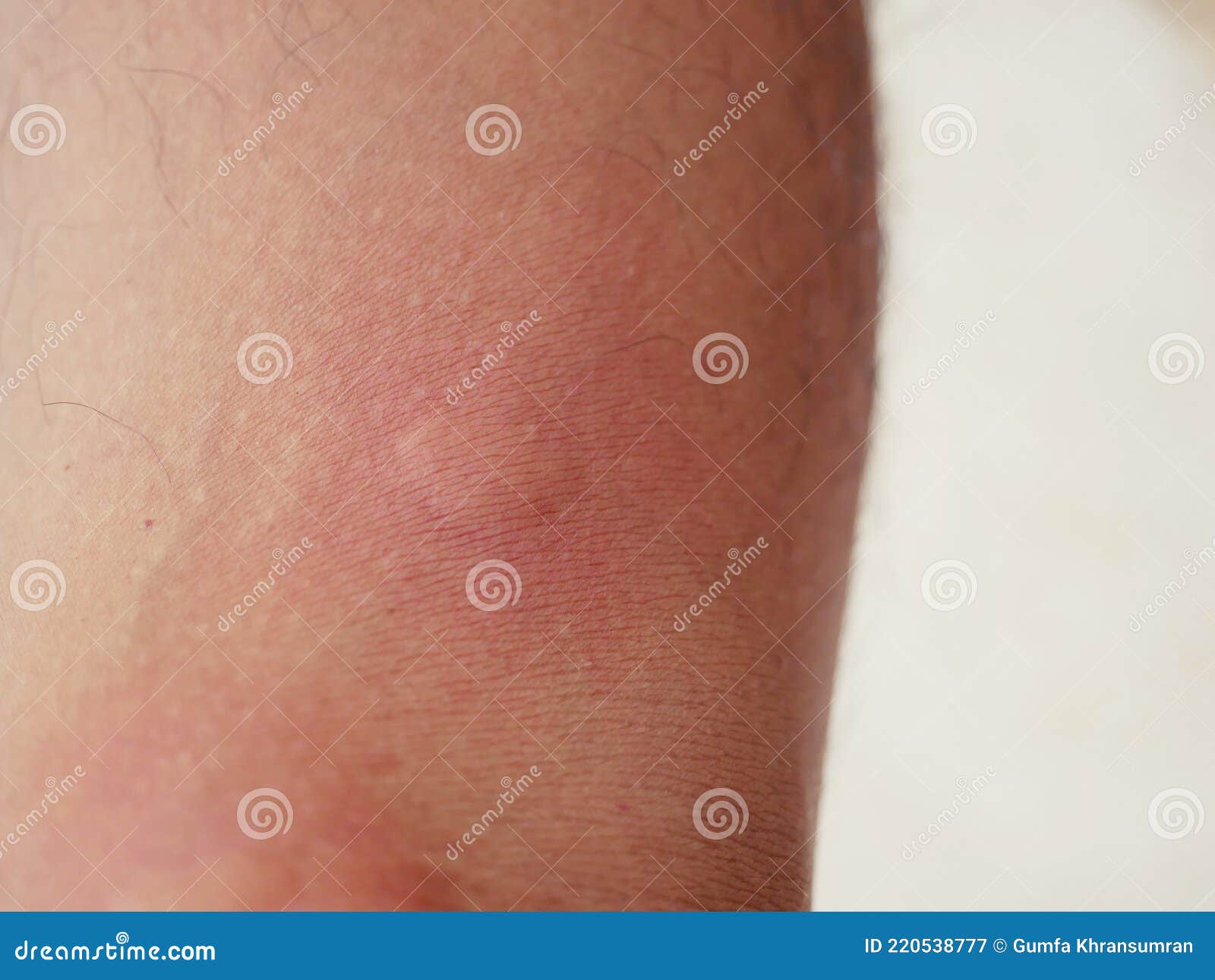 A Bruise that Has Been Stung by an Insect Stock Image - Image of bite ...