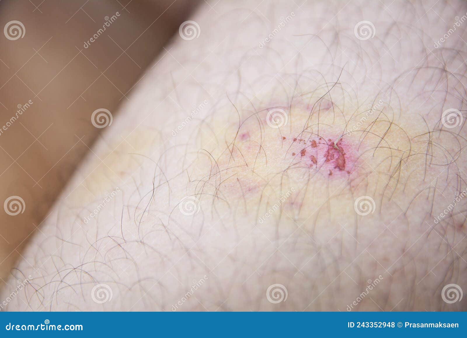 Bruise, hematoma on leg stock photo. Image of doctor - 243352948