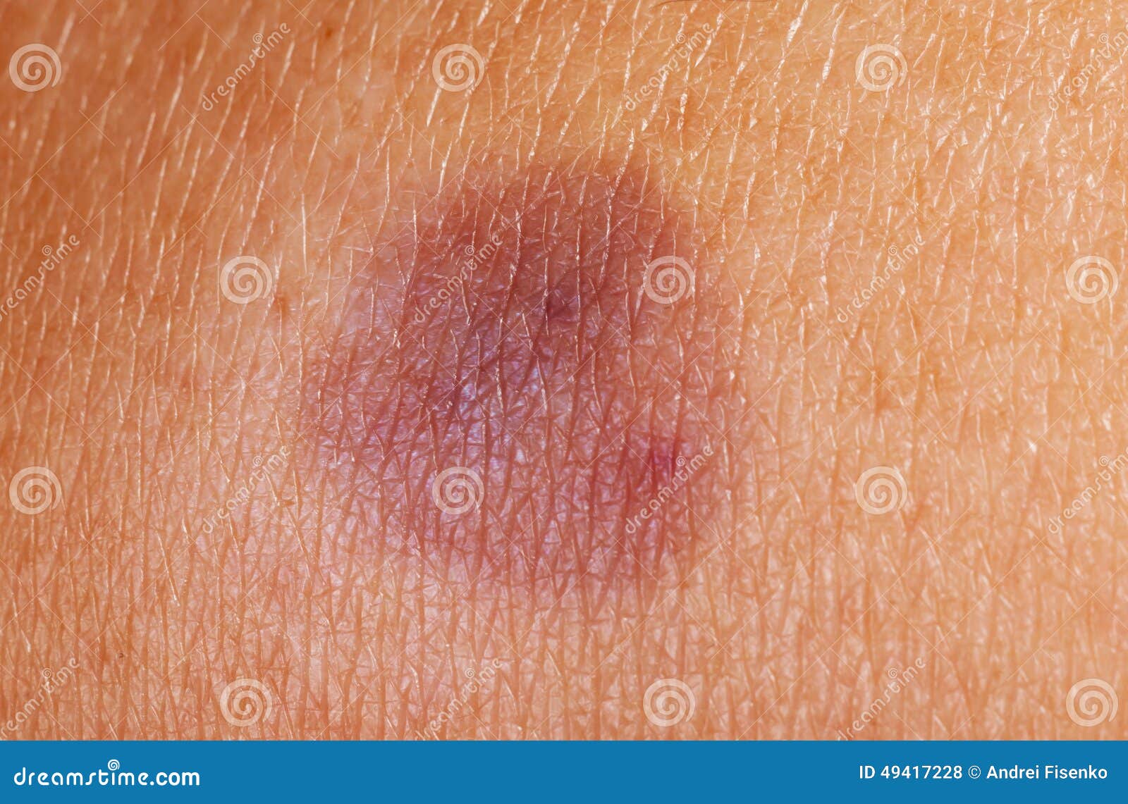 Bruise on the human stock photo. Image of macro, illness - 49417228