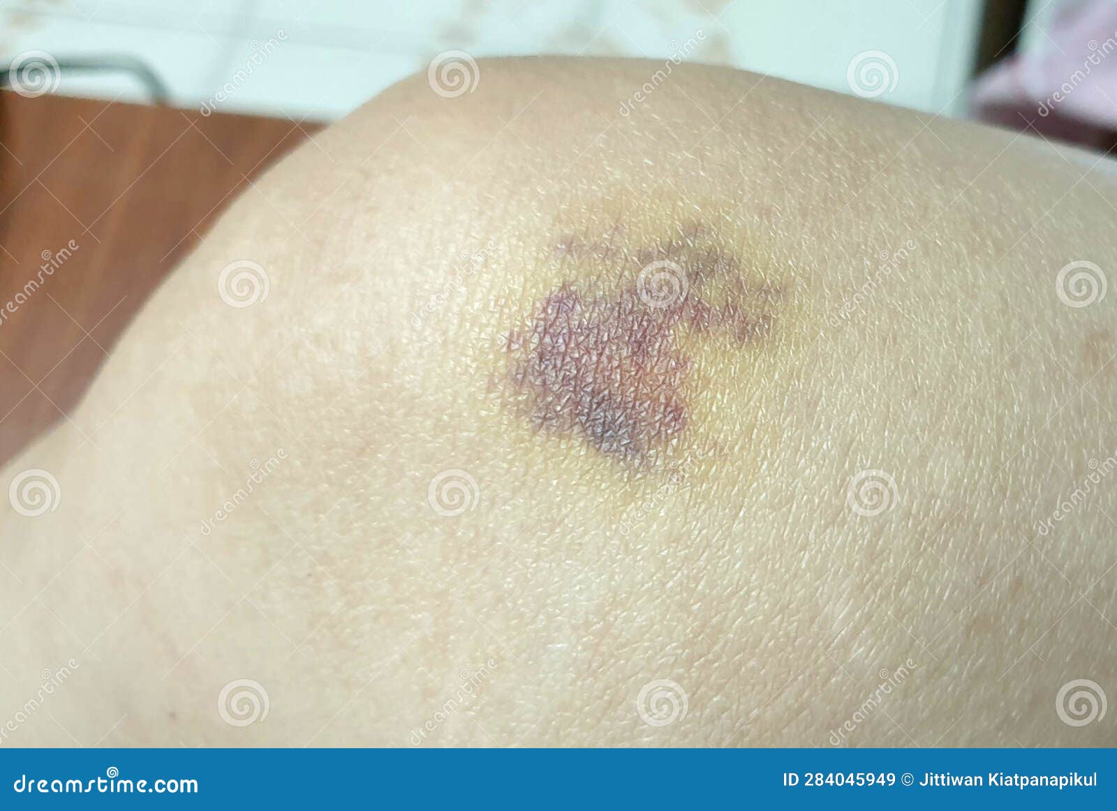 Bruise on the Leg Close up stock image. Image of object - 284045949