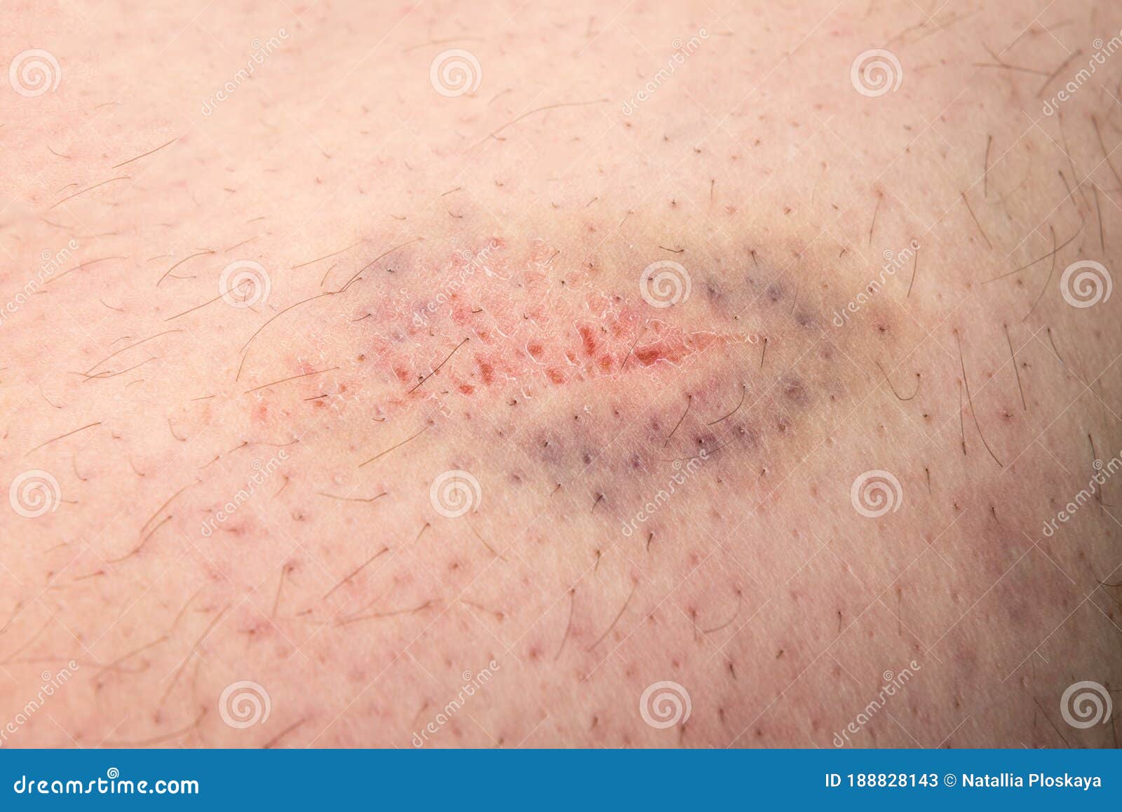 Bruise on male leg skin stock image. Image of human - 188828143