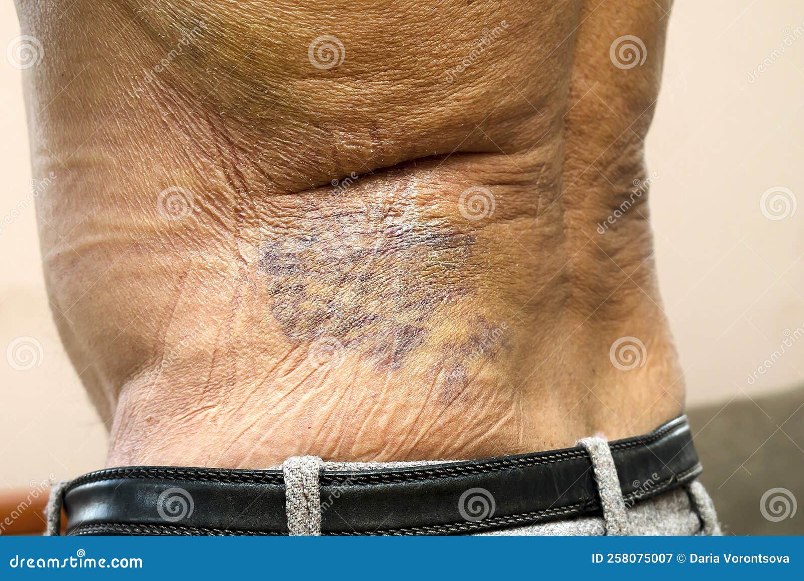 The Bruise on the Man& X27;s Back,coccyx after Falling Down. Man ...