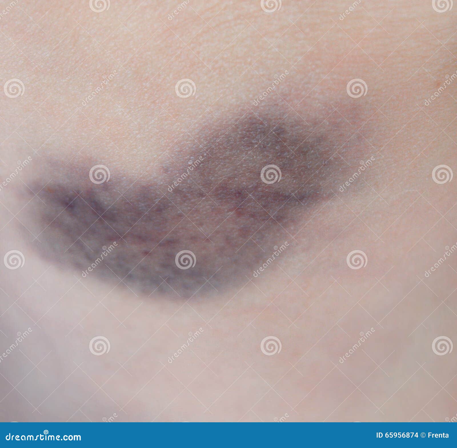 Bruise stock photo. Image of victim, haemorrhage, bruise - 65956874