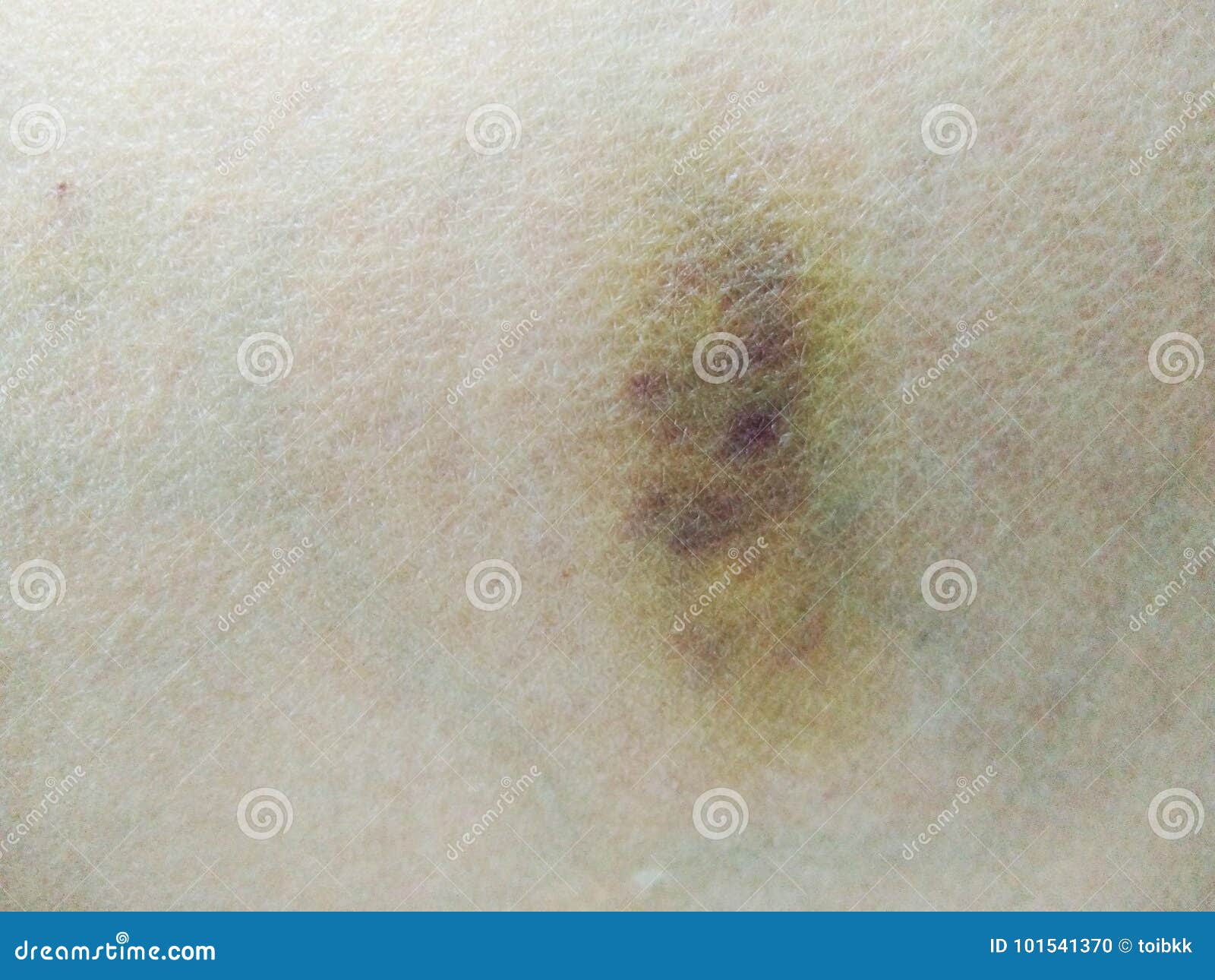 Bruise on skin stock photo. Image of injure, skins, discoloration ...