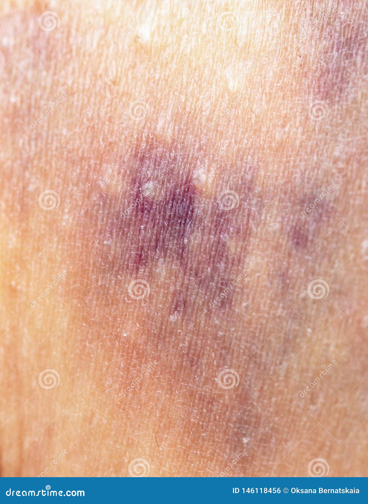 Bruise on the skin stock photo. Image of fall, girl - 146118456
