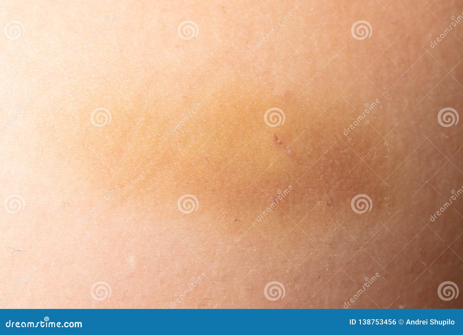 A Bruise on the Skin of a Man Stock Photo - Image of physical, macro ...