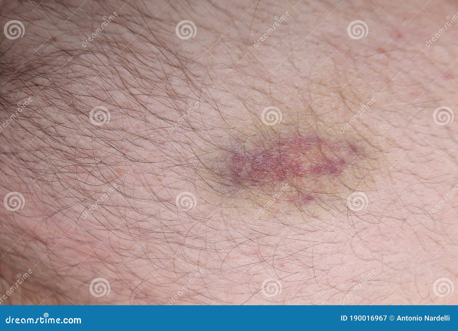 Bruise on skin stock image. Image of injured, medicine - 190016967