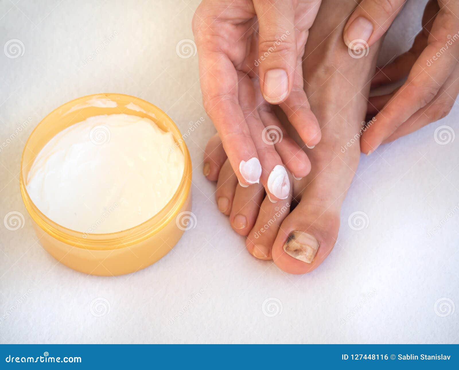 Bruise on the Toe of the Foot. Foot Problems. Stock Photo - Image of ...