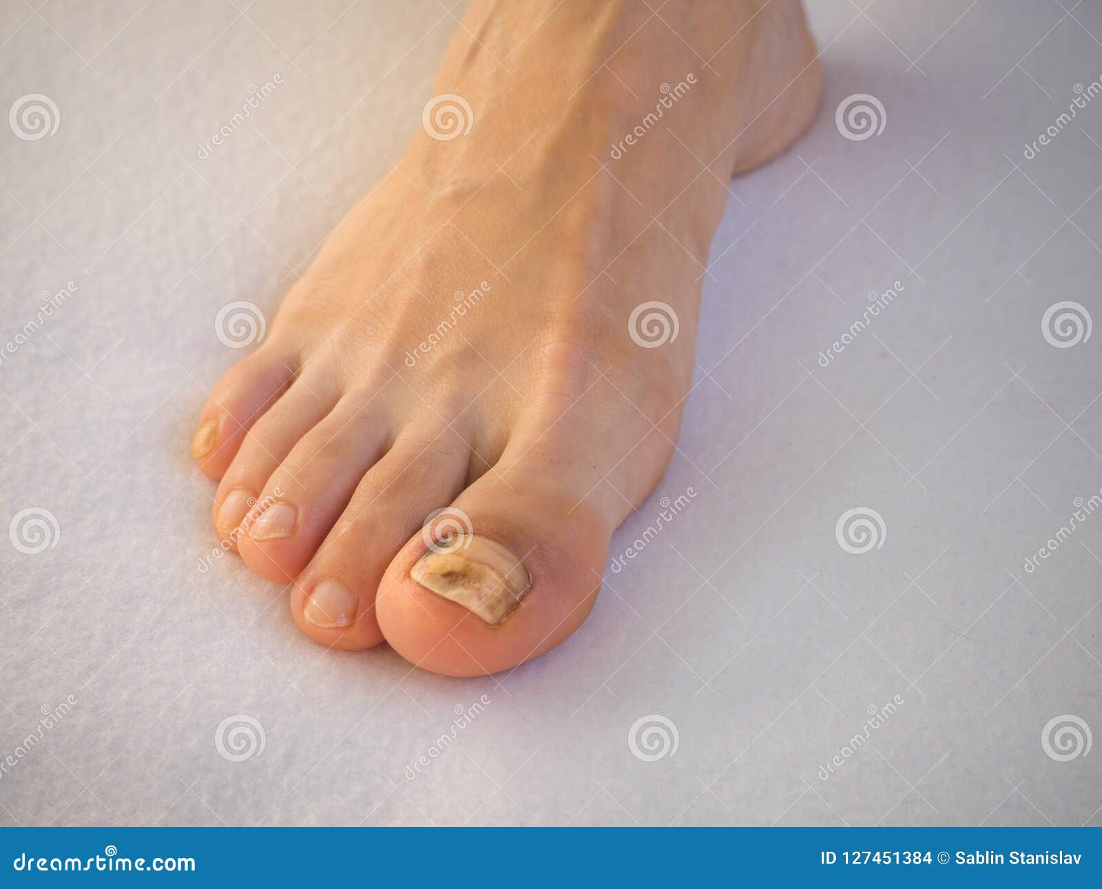 Bruise on the Toe of the Foot. Foot Problems. Stock Photo - Image of ...