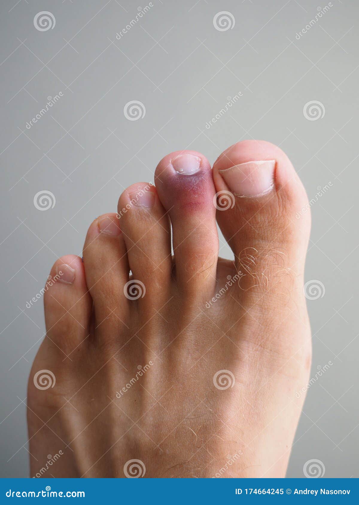 A bruise on the toe. stock image. Image of acute, finger - 174664245