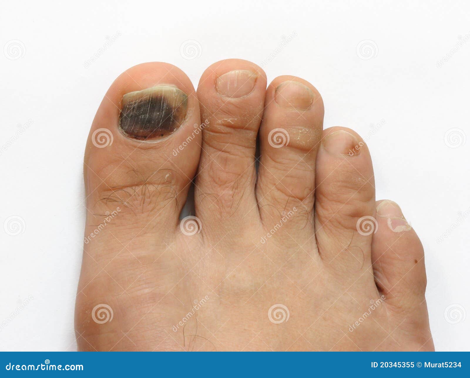 Bruise on toe nail stock image. Image of bare, infection - 20345355