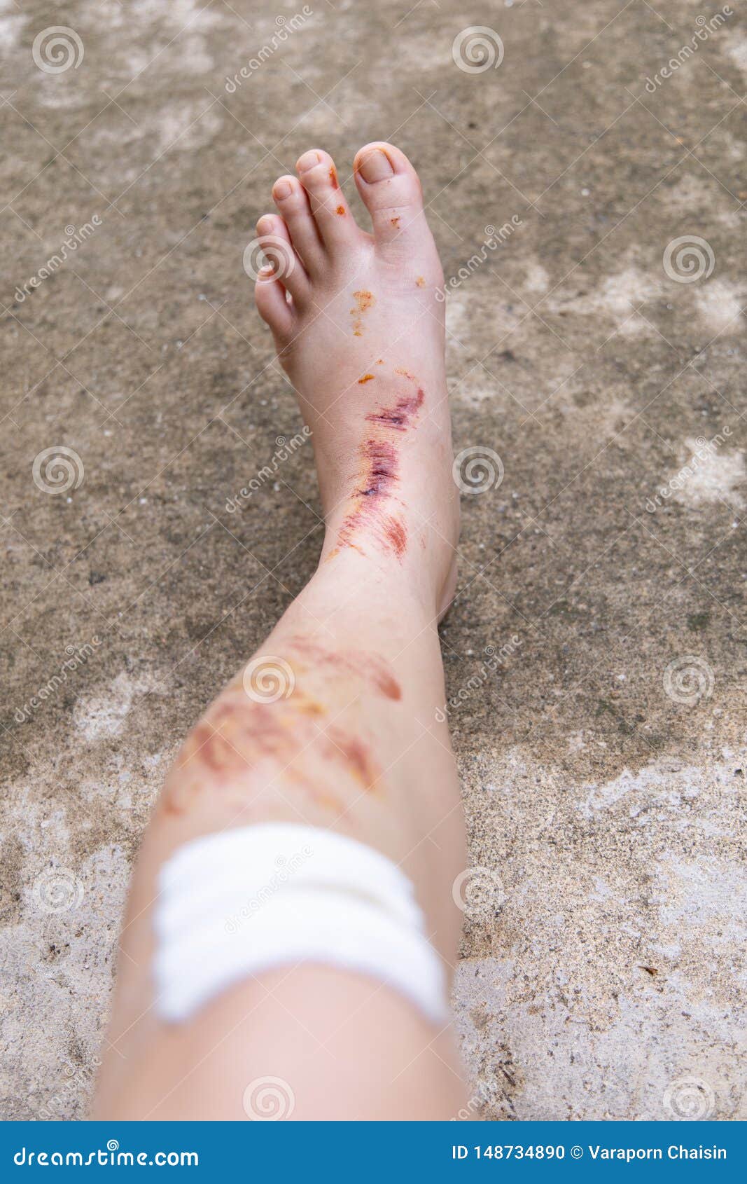 Bruise Wound on Woman`s Foot Stock Photo - Image of accident, injured ...
