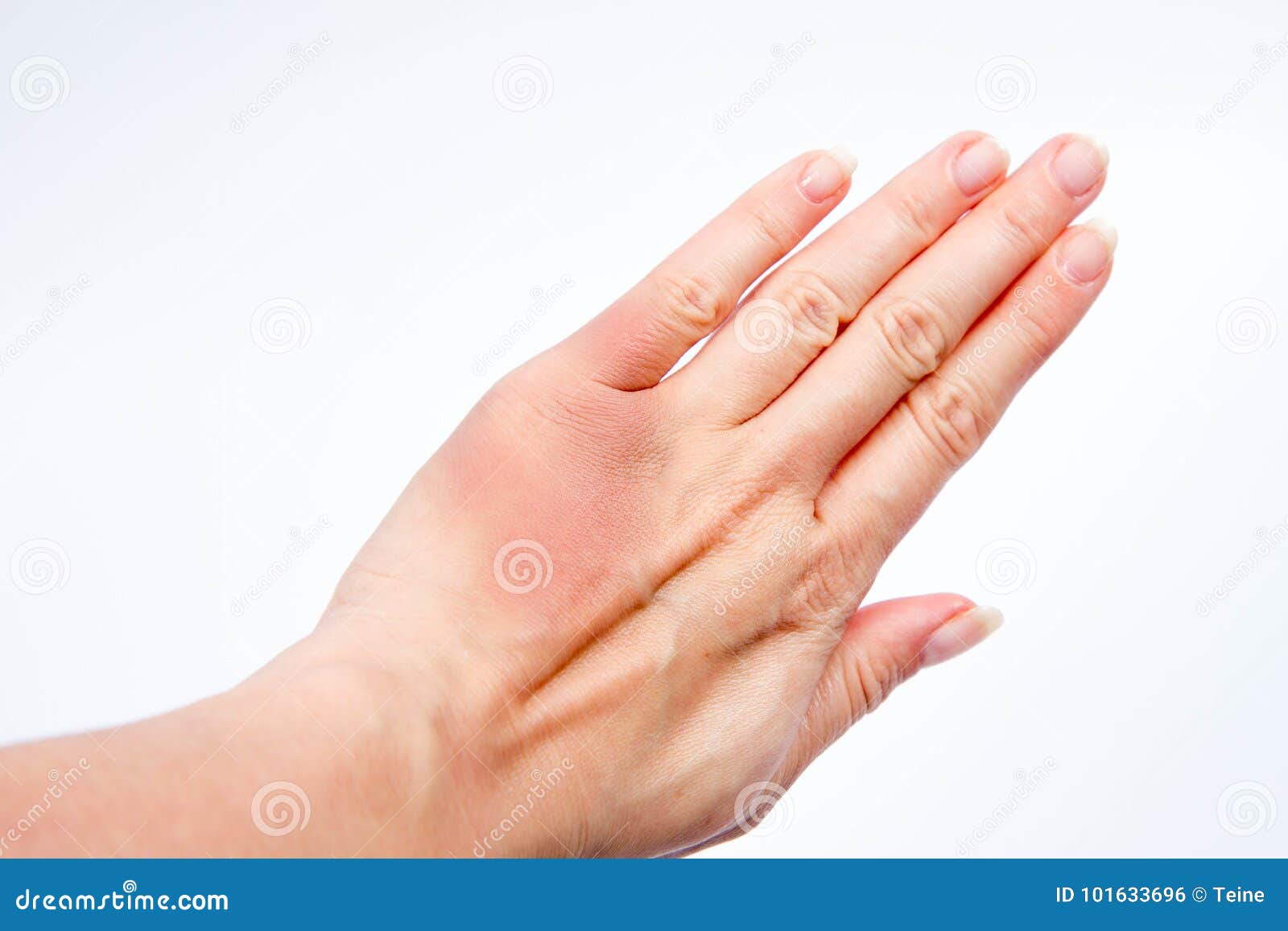 Bruised hand stock photo. Image of autopsy, batter, womans - 101633696