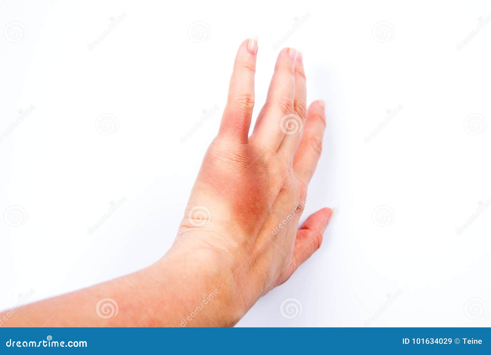Bruised hand stock image. Image of violence, batter - 101634029
