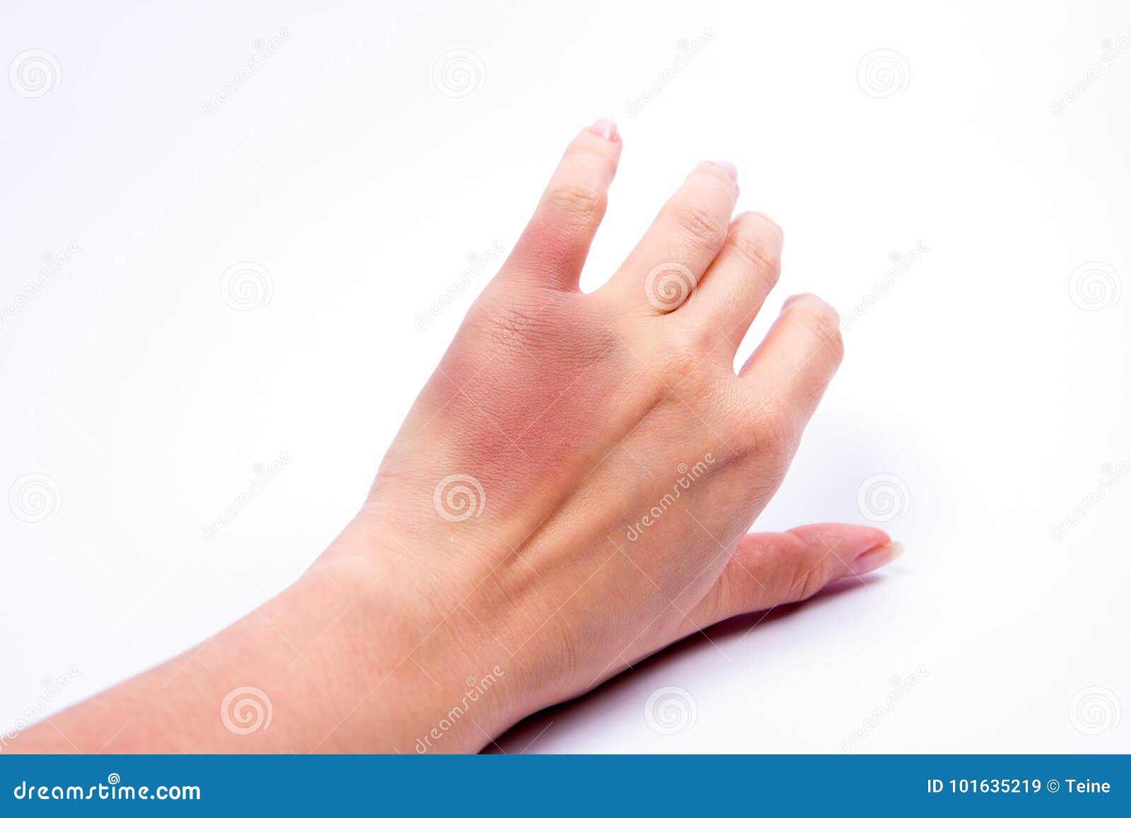 Bruised Hand Stock Photos - Download 442 Images