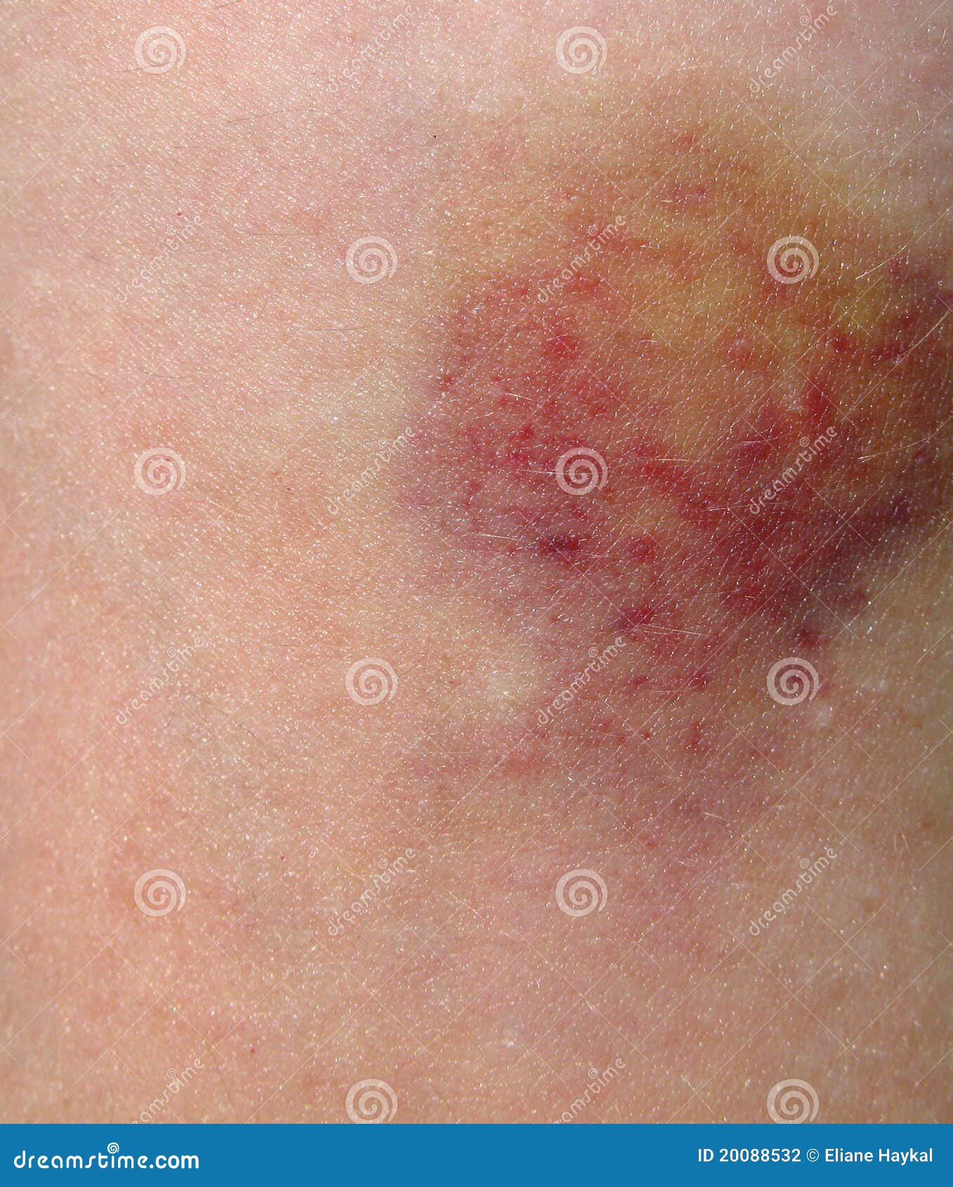 Bruised Skin stock photo. Image of hurt, healthcare, human - 20088532