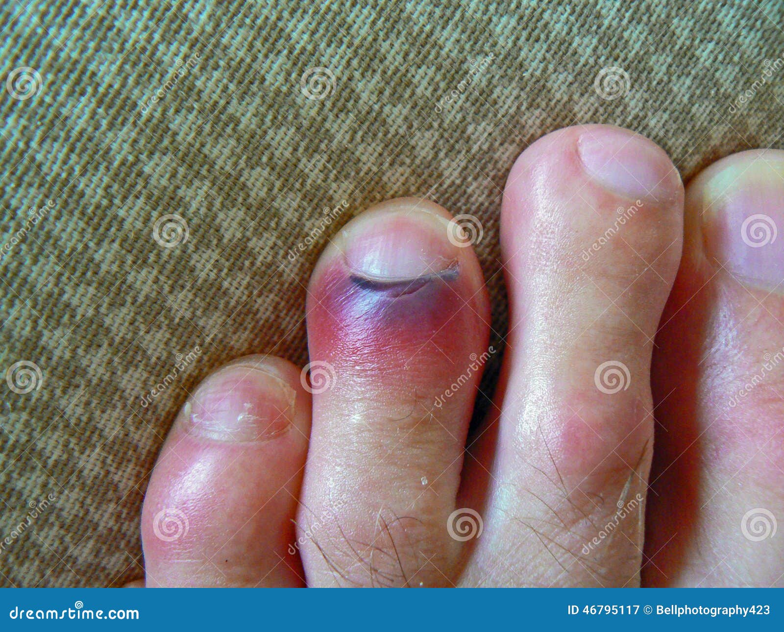 Bruised toe stock image. Image of feet, health, medical - 46795117