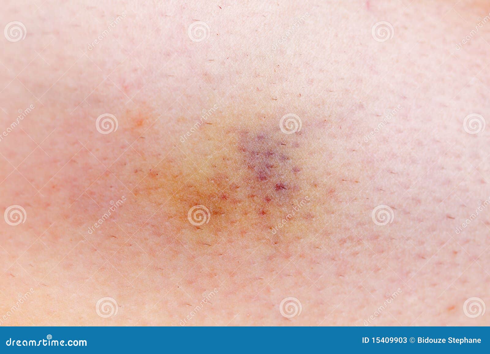 Bruised woman skin stock image. Image of disease, discoloration - 15409903
