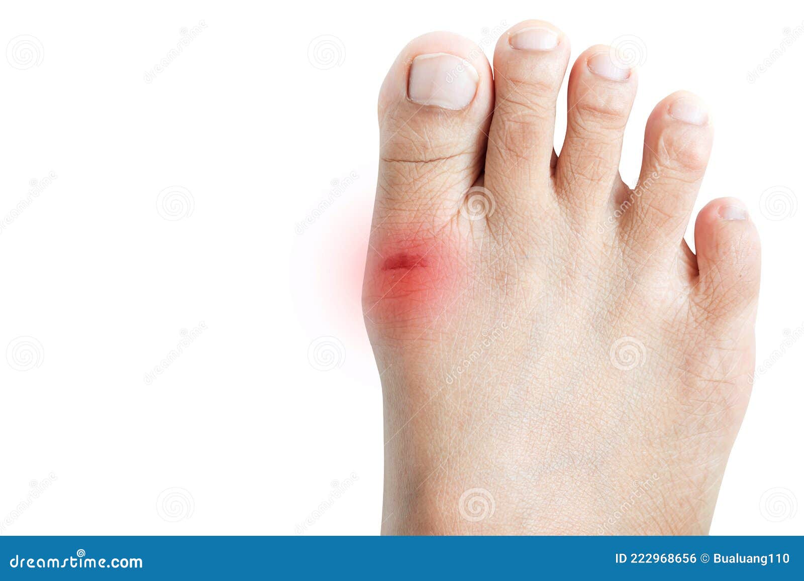Bruised Wound Injury At The Foot On A White Background Royalty-Free ...