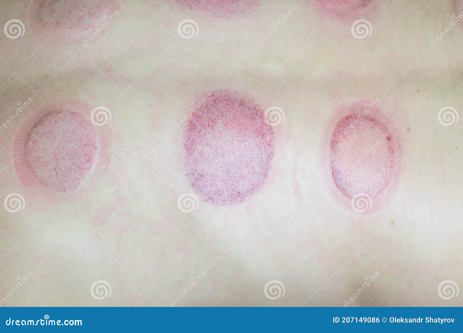 Bruises on the Back after Cupping. Stock Photo - Image of hematoma ...