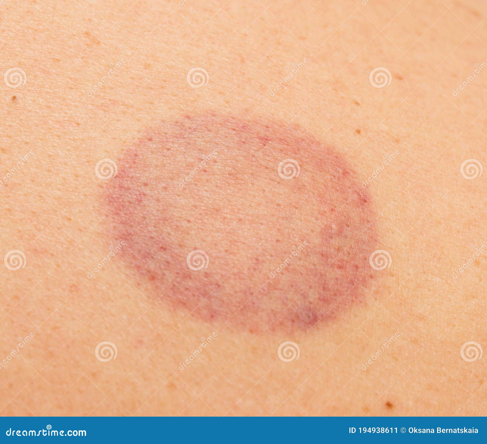 Bruises on the Skin of the Back Stock Image - Image of bruises ...