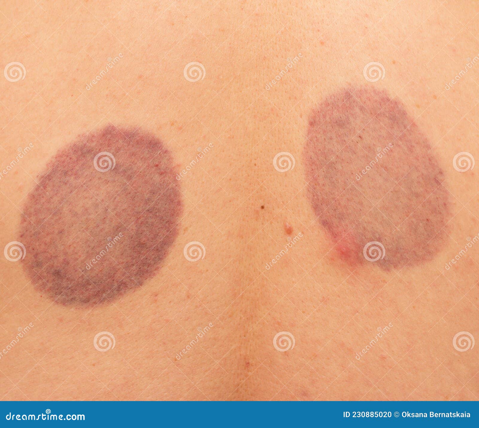 Bruises on the Skin of the Back Stock Photo - Image of medicine ...