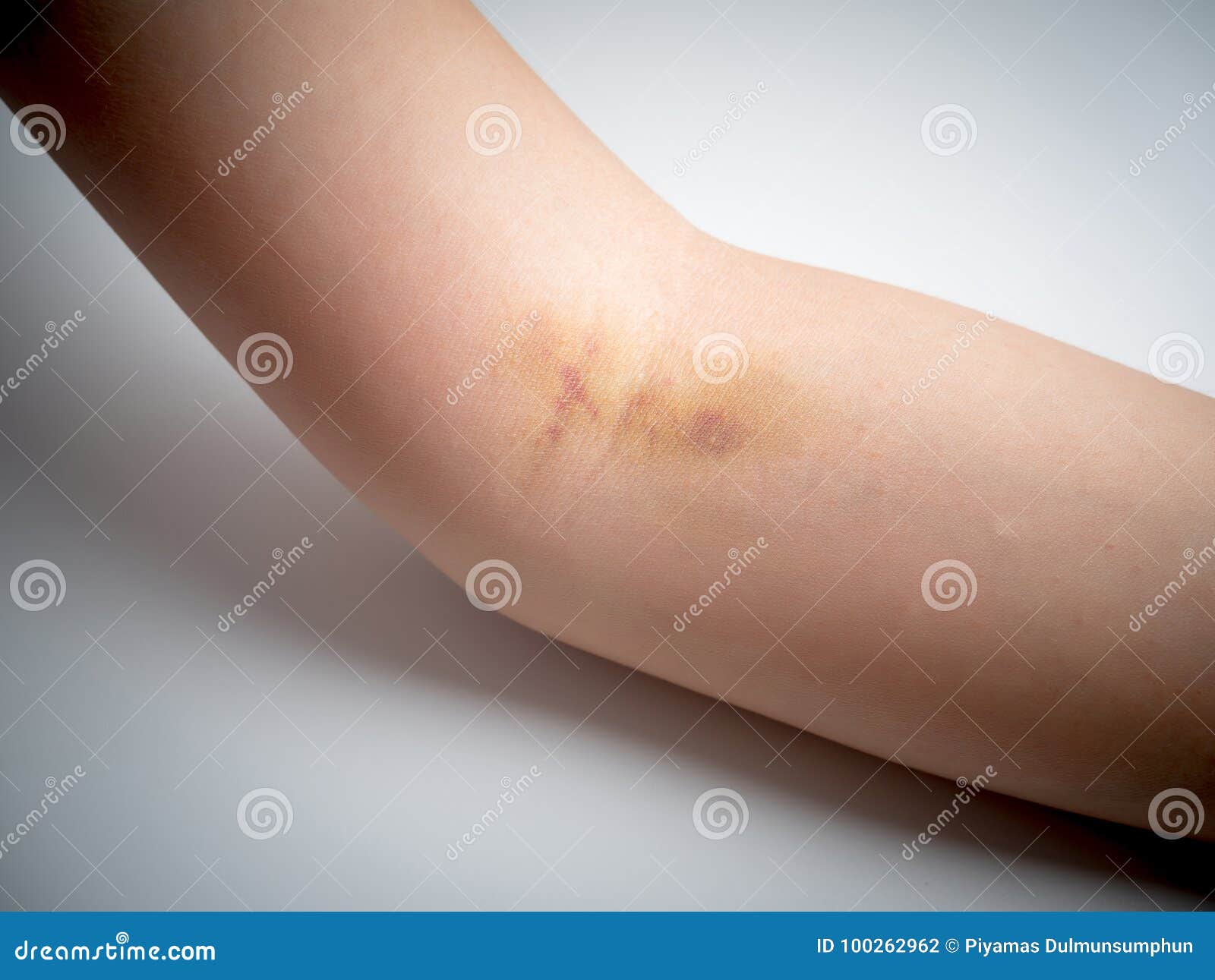 Bruises on woman arm skin stock photo. Image of female - 100262962