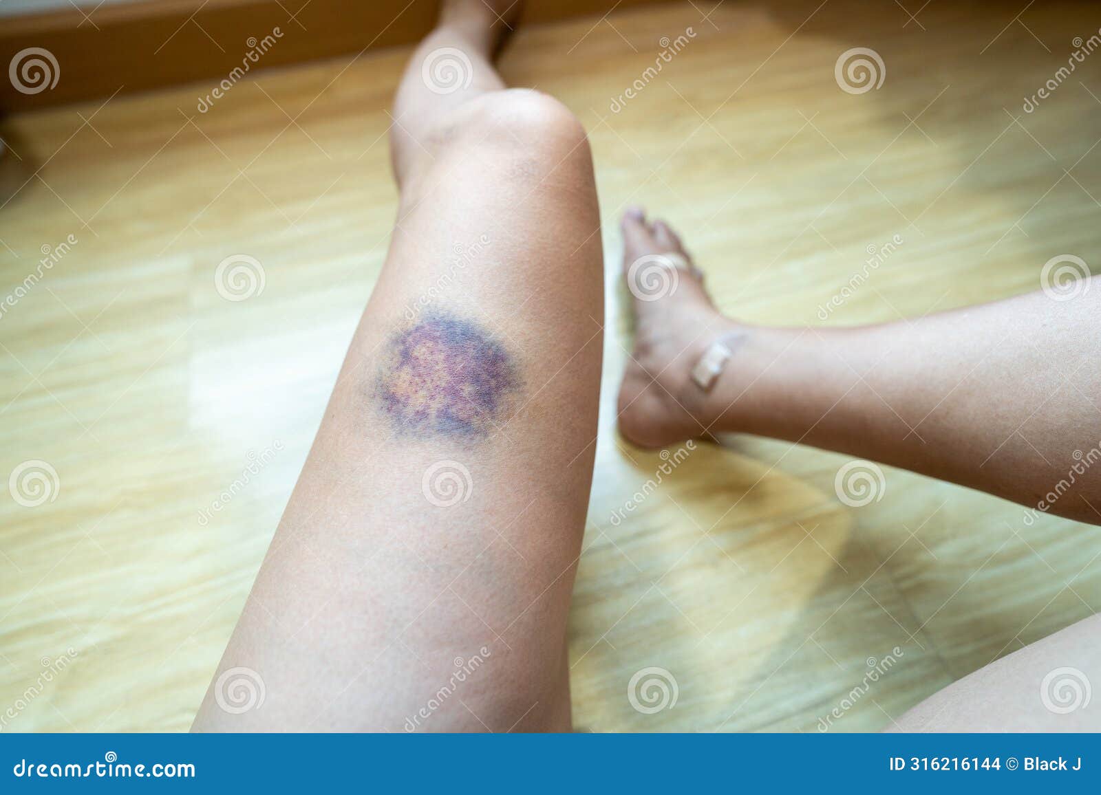 Bruises on Women S Legs, Accident Stock Photo - Image of human, concept ...