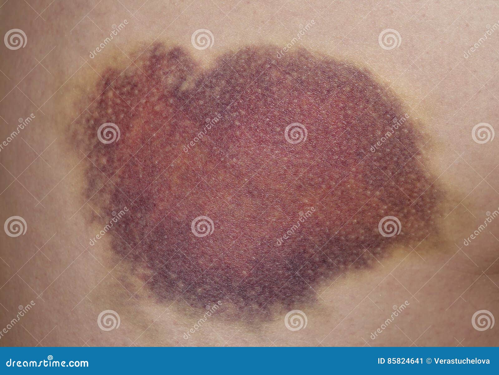 Bruising Stock Photos - Download 532 Royalty Free Photos