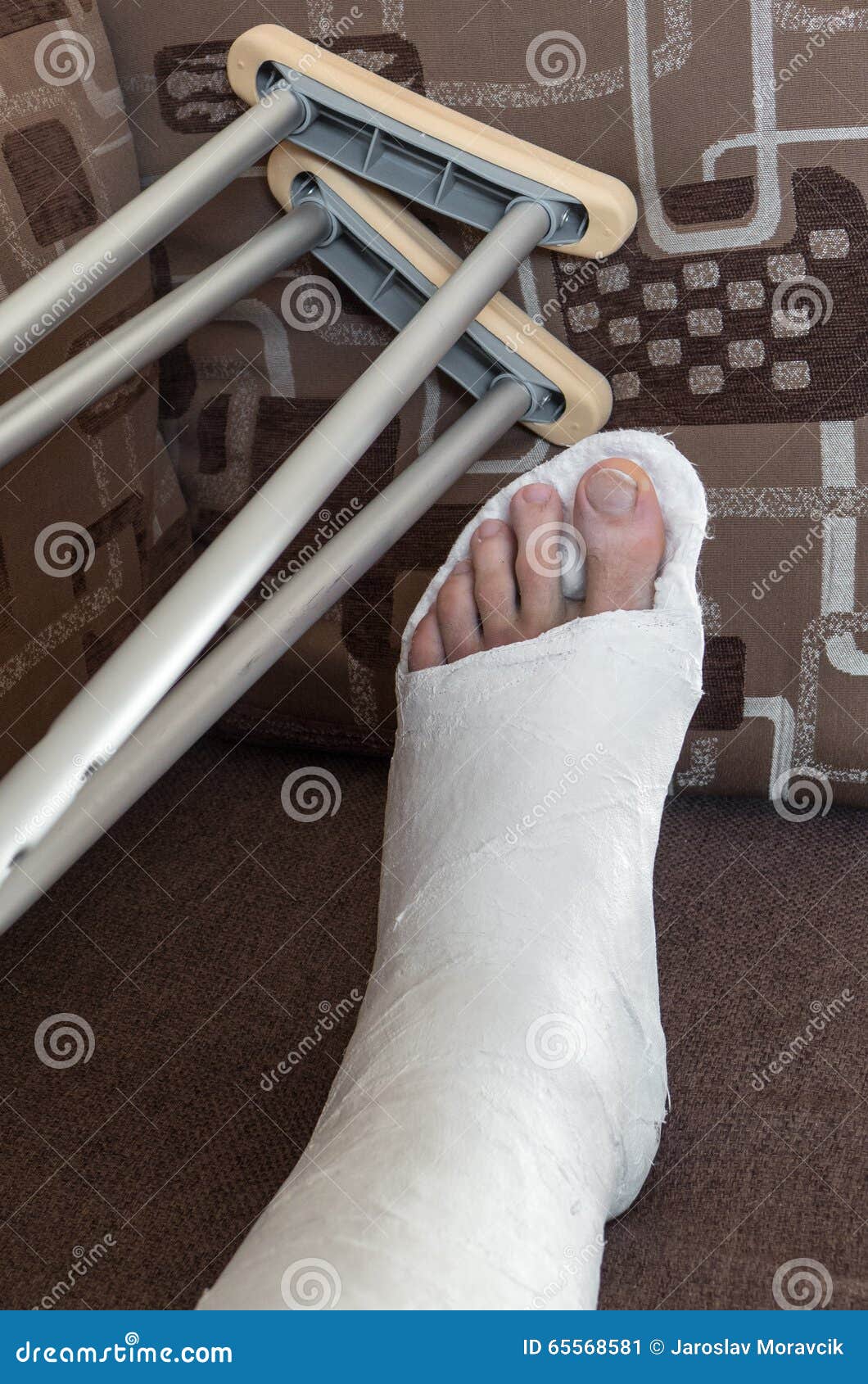 Bruten ankel i gips fotografering för bildbyråer. Bild av gips - 65568581
