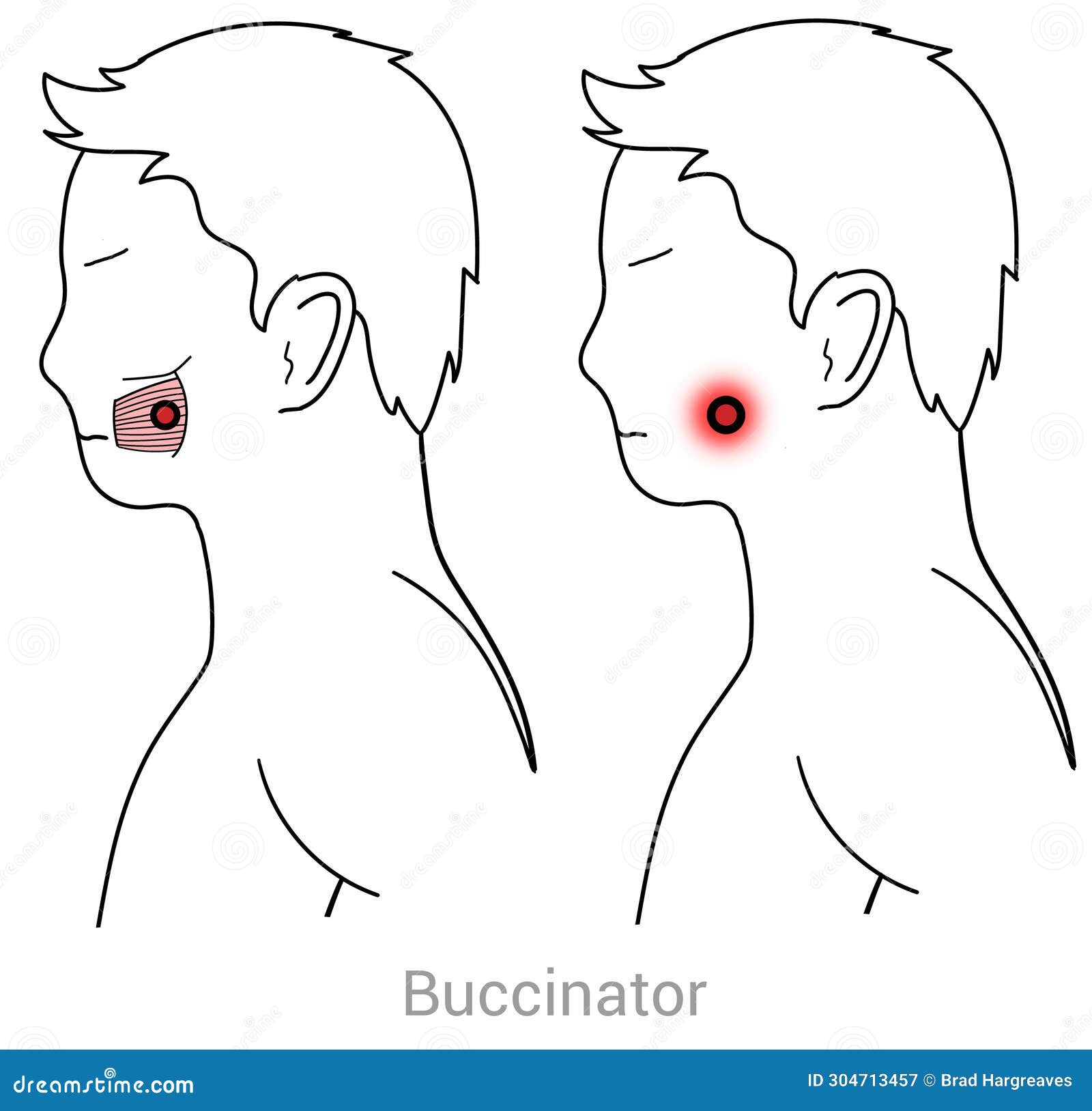 Buccinator Myofascial Trigger Points Can Make Chewing Difficult And ...