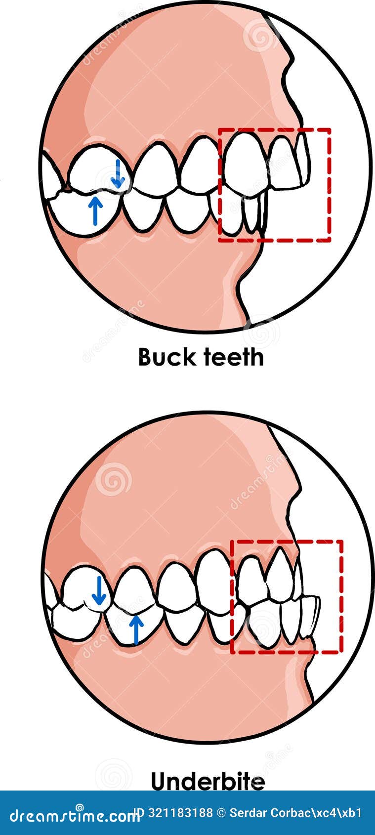 Bucco-version Tooth an Outward Positioning of the Teeth Projecting ...