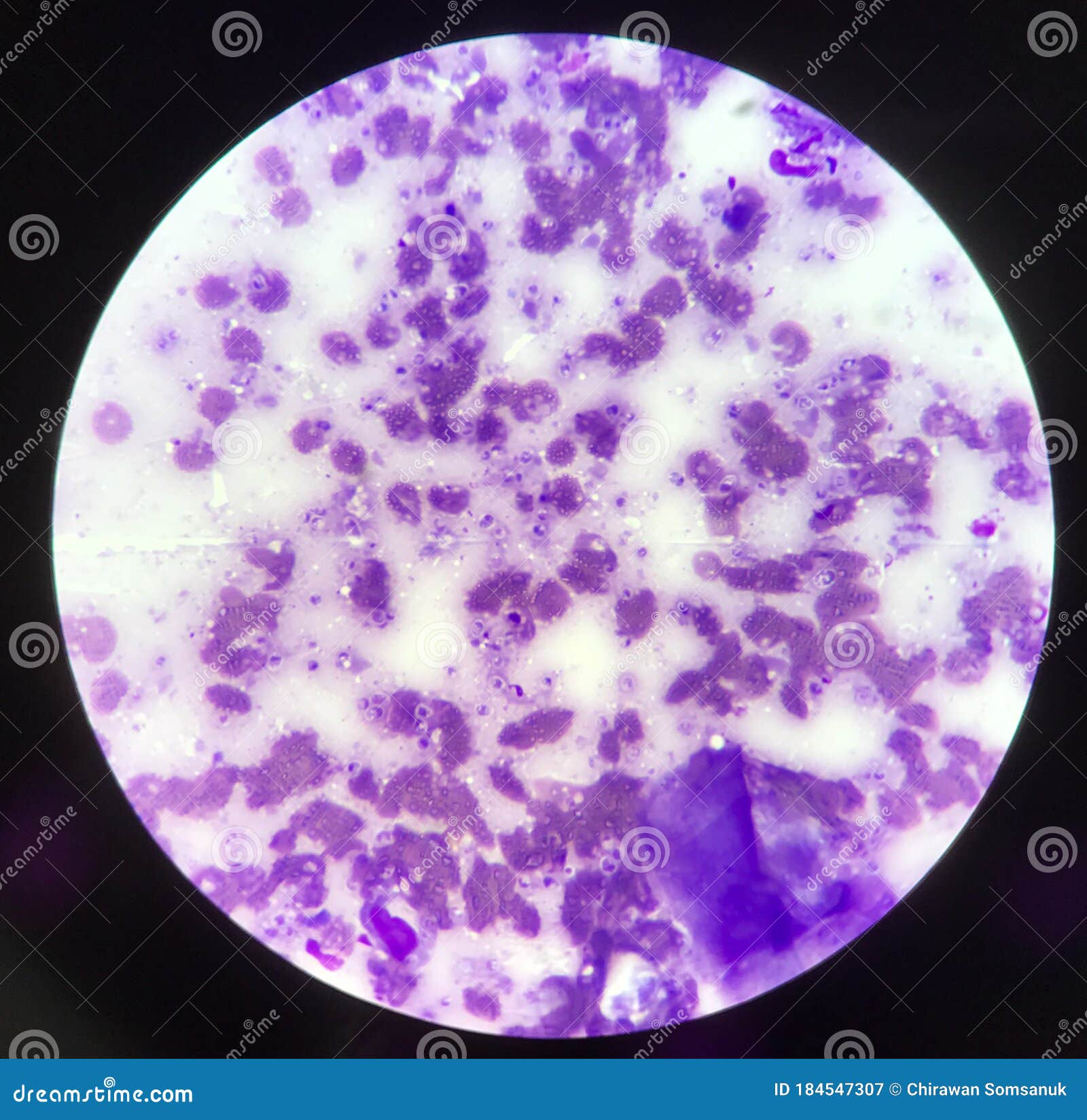 Cryptococcus Neoformans In Lung Tissue - Warthin Starry Silver Stain ...