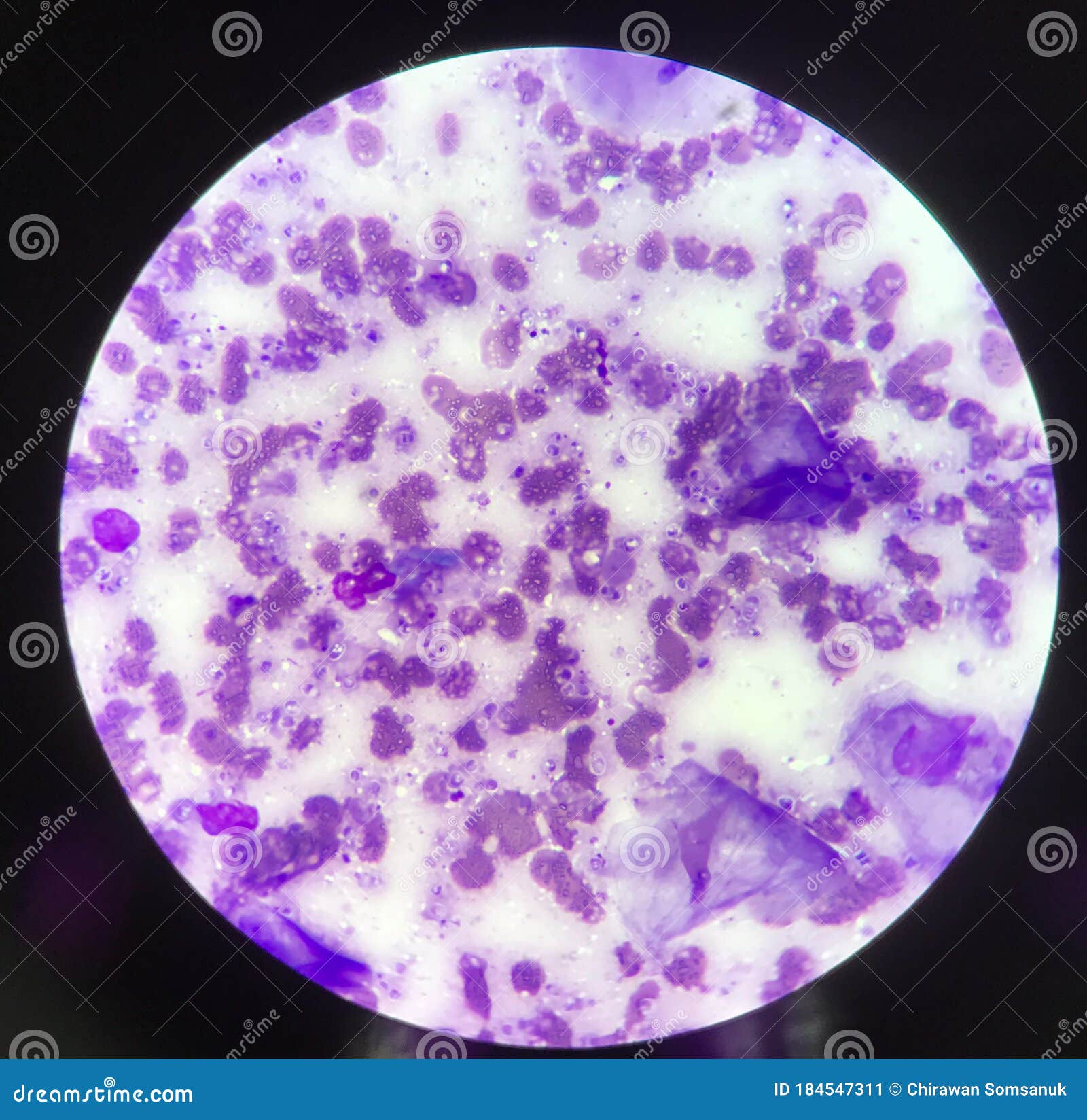 Cryptococcus Neoformans In Lung Tissue - Warthin Starry Silver Stain ...