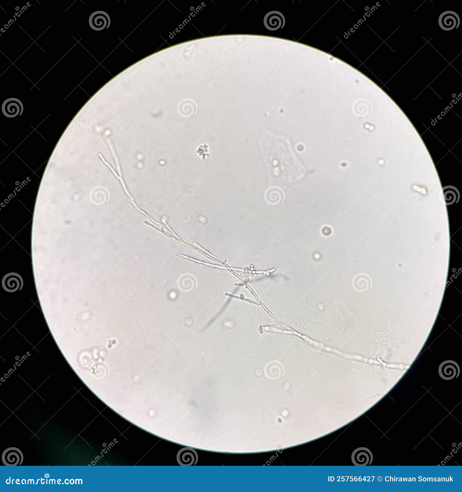 Budding Yeast Cells with Pseudohyphae in Urine Sample Stock Image ...