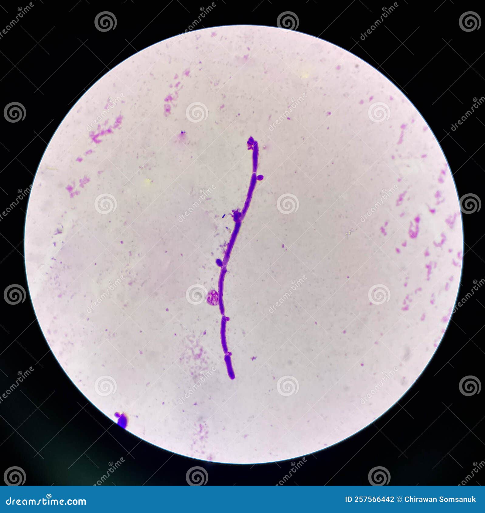 Budding Yeast Cells with Pseudohyphae in Urine Sample on Wright Gimsa ...