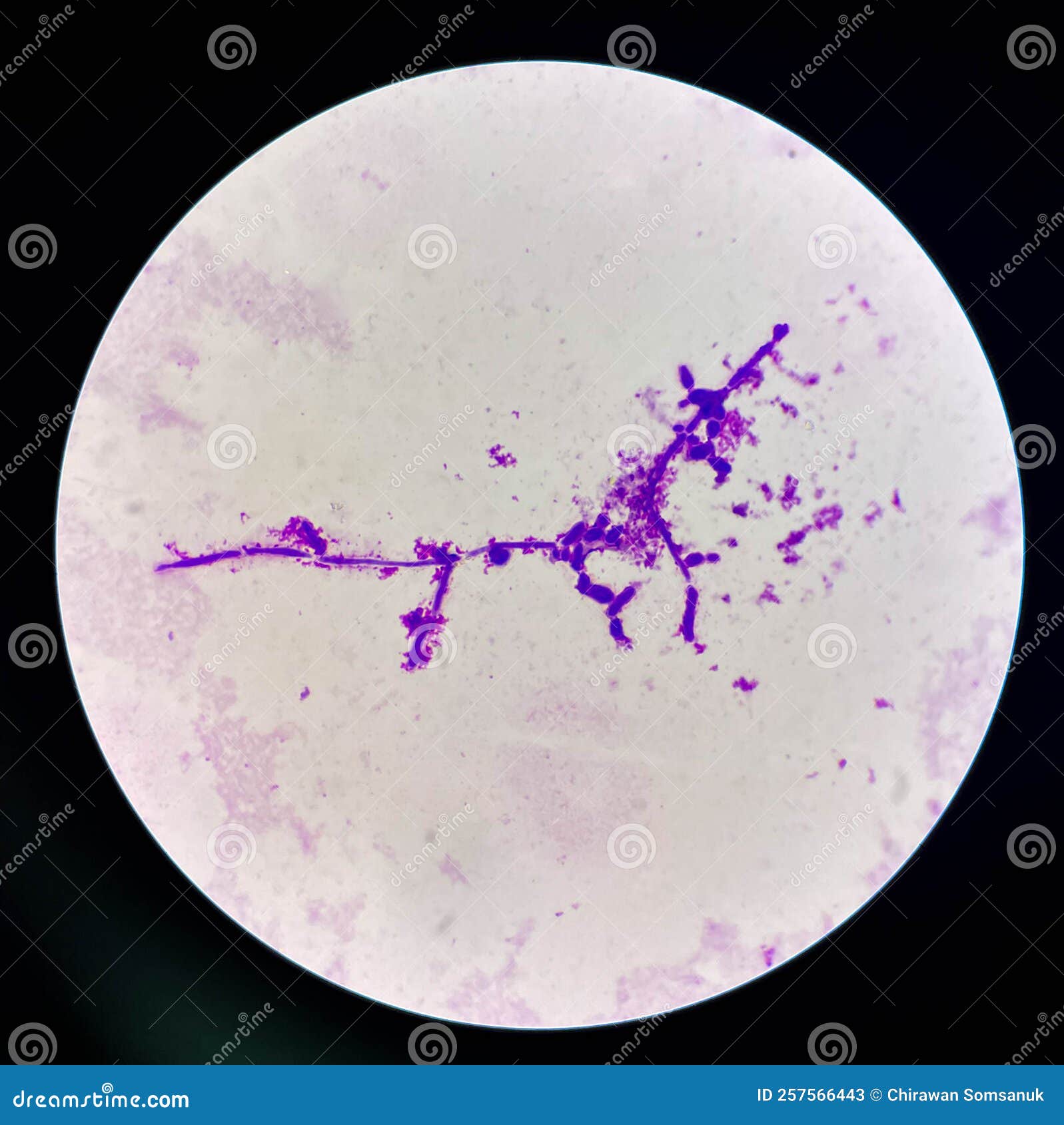 Budding Yeast Cells With Pseudohyphae In Urine Sample On Wright Gimsa ...