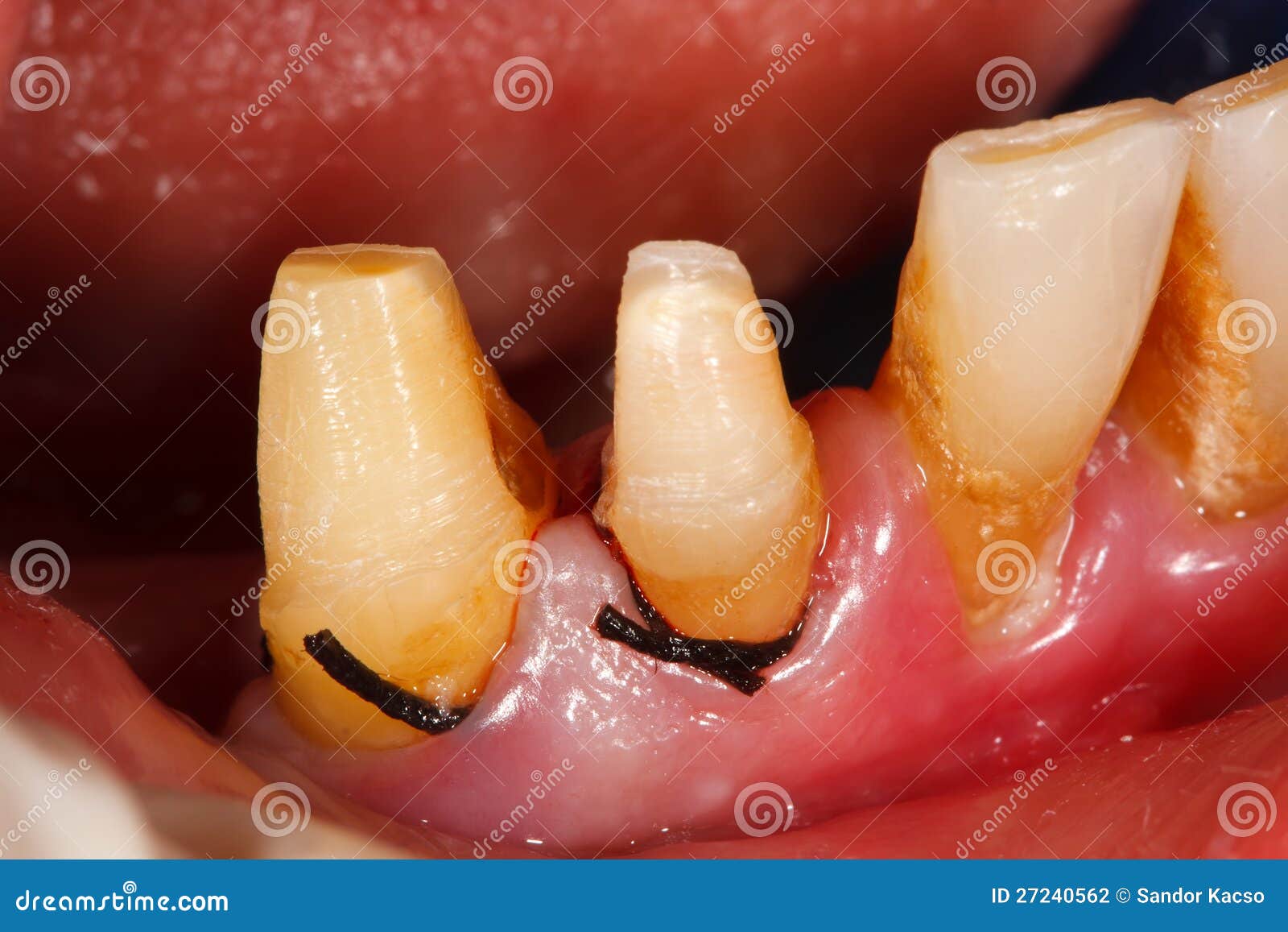 Buffed Teeth before Imprinting Stock Photo - Image of office, buffed ...