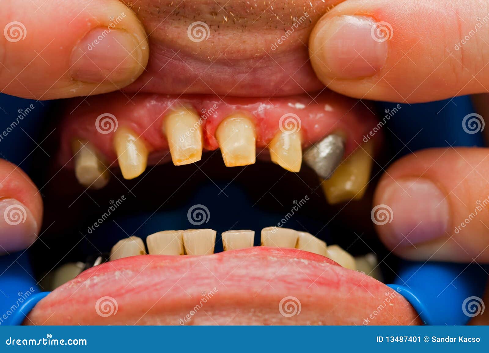 Buffed Teeth - Prosthetic Rehabilitation Stock Image - Image of close ...