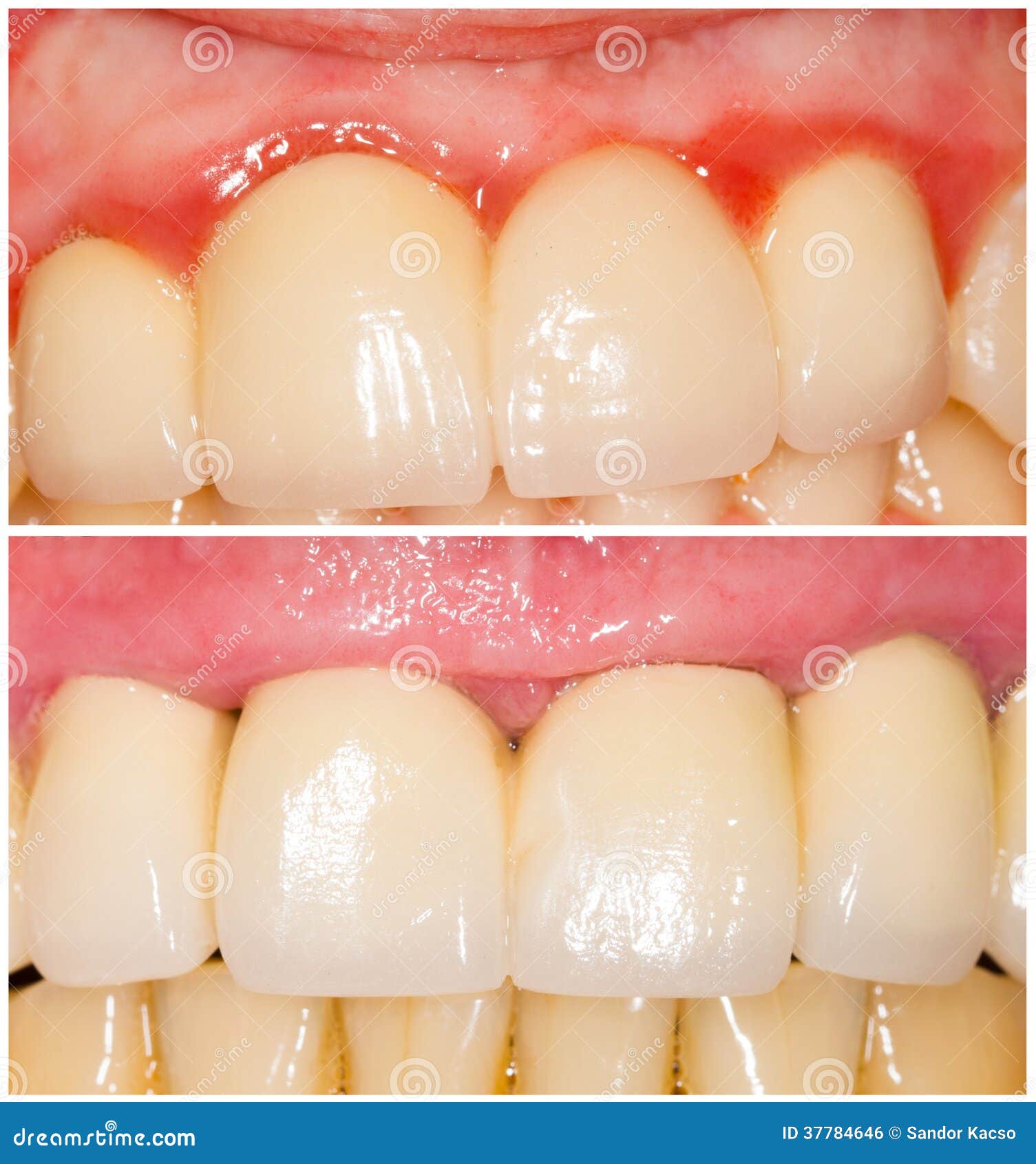 Buffing Teeth Tangent and with Shoulder Stock Photo - Image of ...