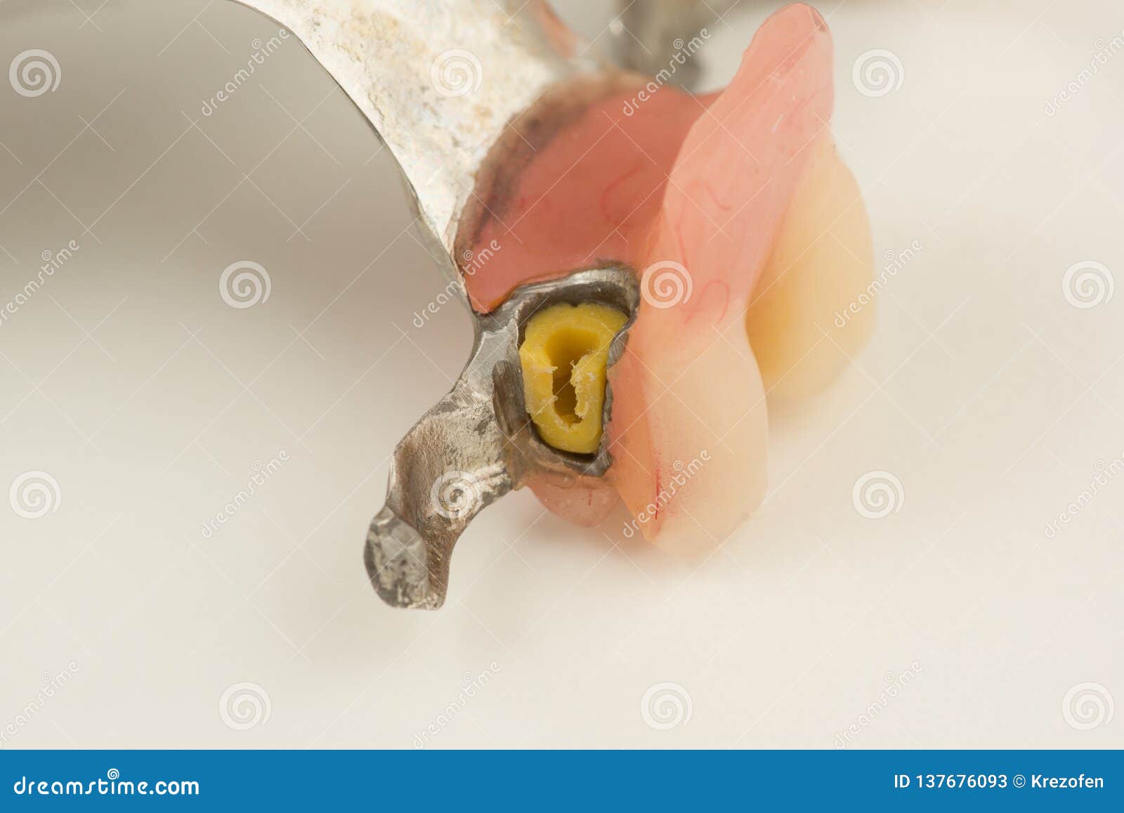 Bugel Remove Dentures with Attachments Stock Image - Image of attachmen ...