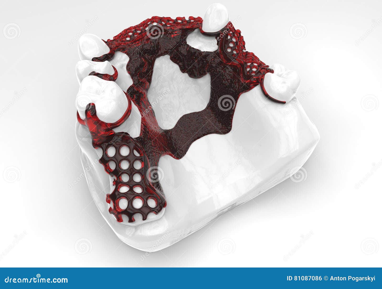 Bugel vax stock photo. Image of dental, model1, layers - 81087086