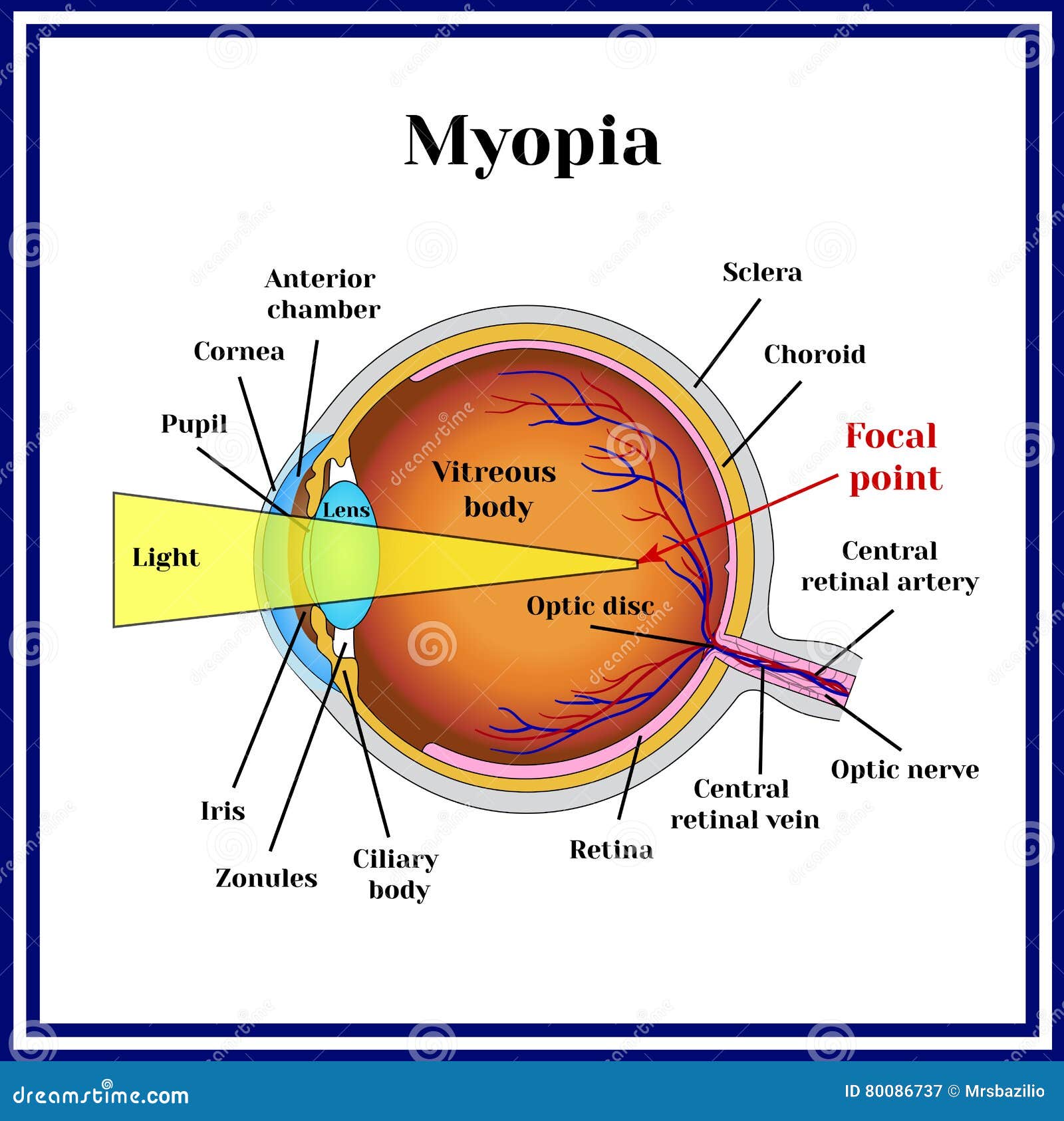 Bulbo Oculare Rifrangente Di Errori Miopia Medicina Illustrazione ...