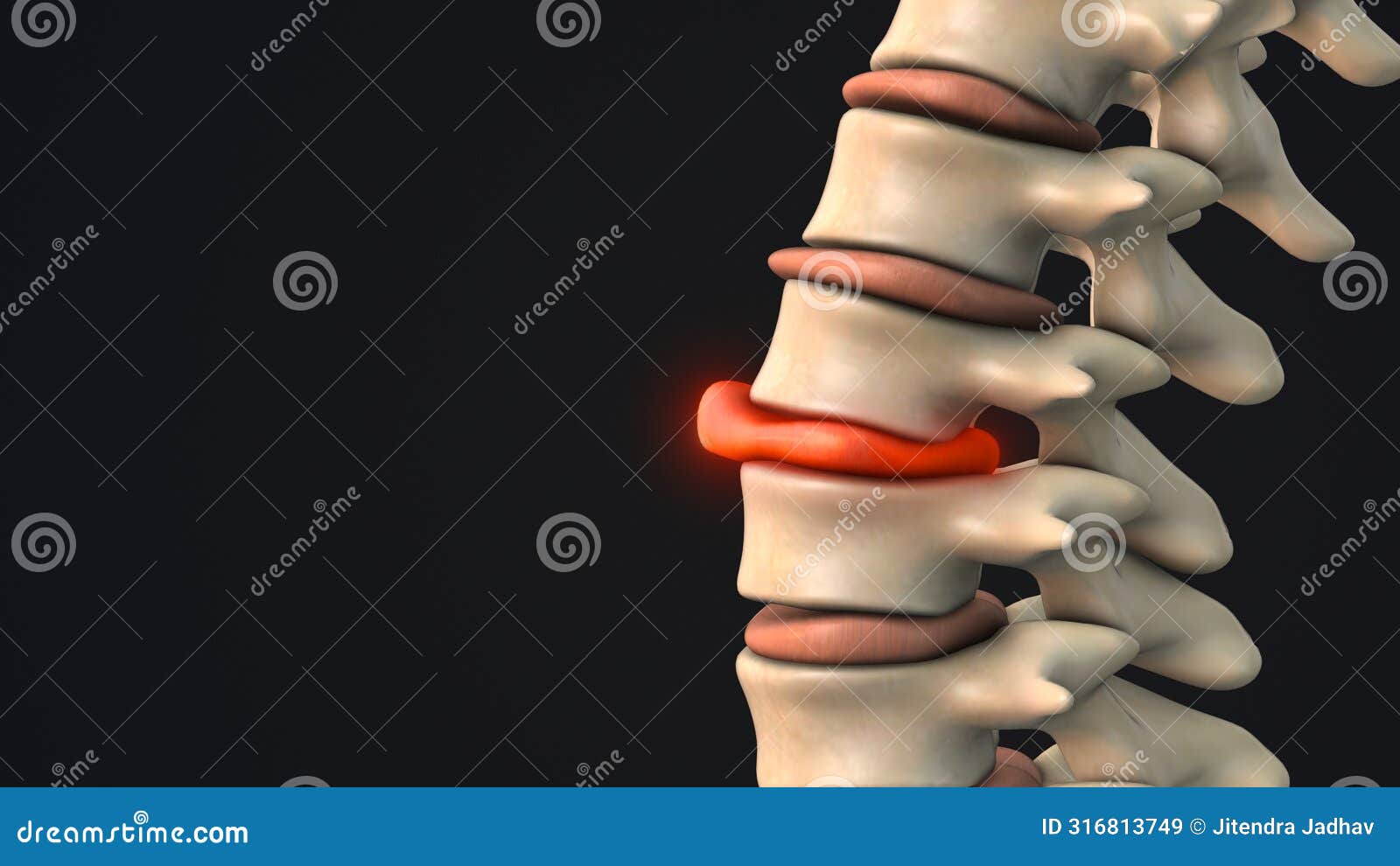 Bulging Disc In The Human Spine Royalty-Free Stock Photo ...